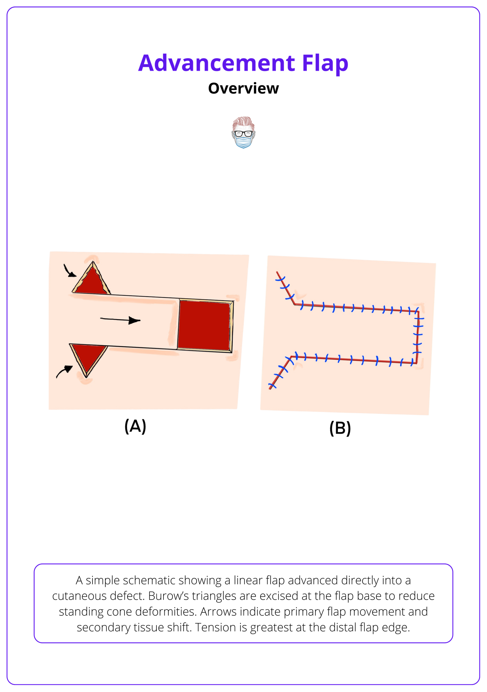 Advancement Flap: Design Principles, Indications, & Common Variants