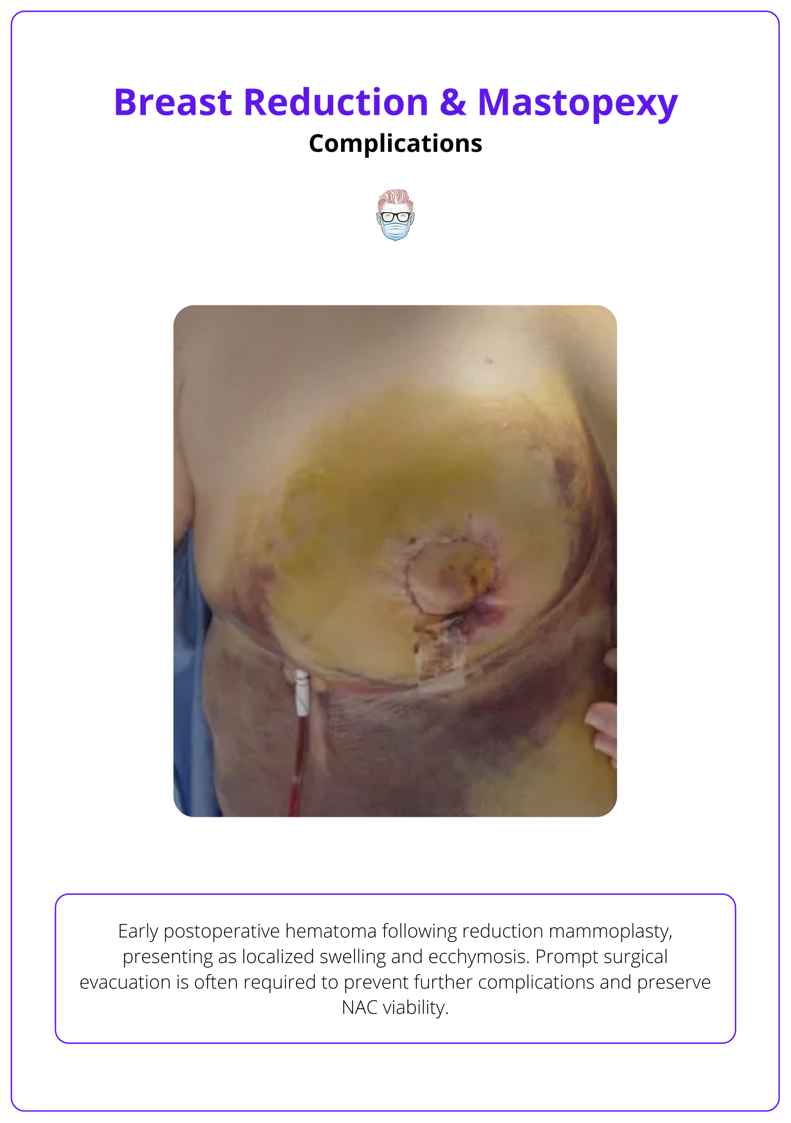 Breast Reduction and Mastopexy: Anatomy, Techniques, & Complications