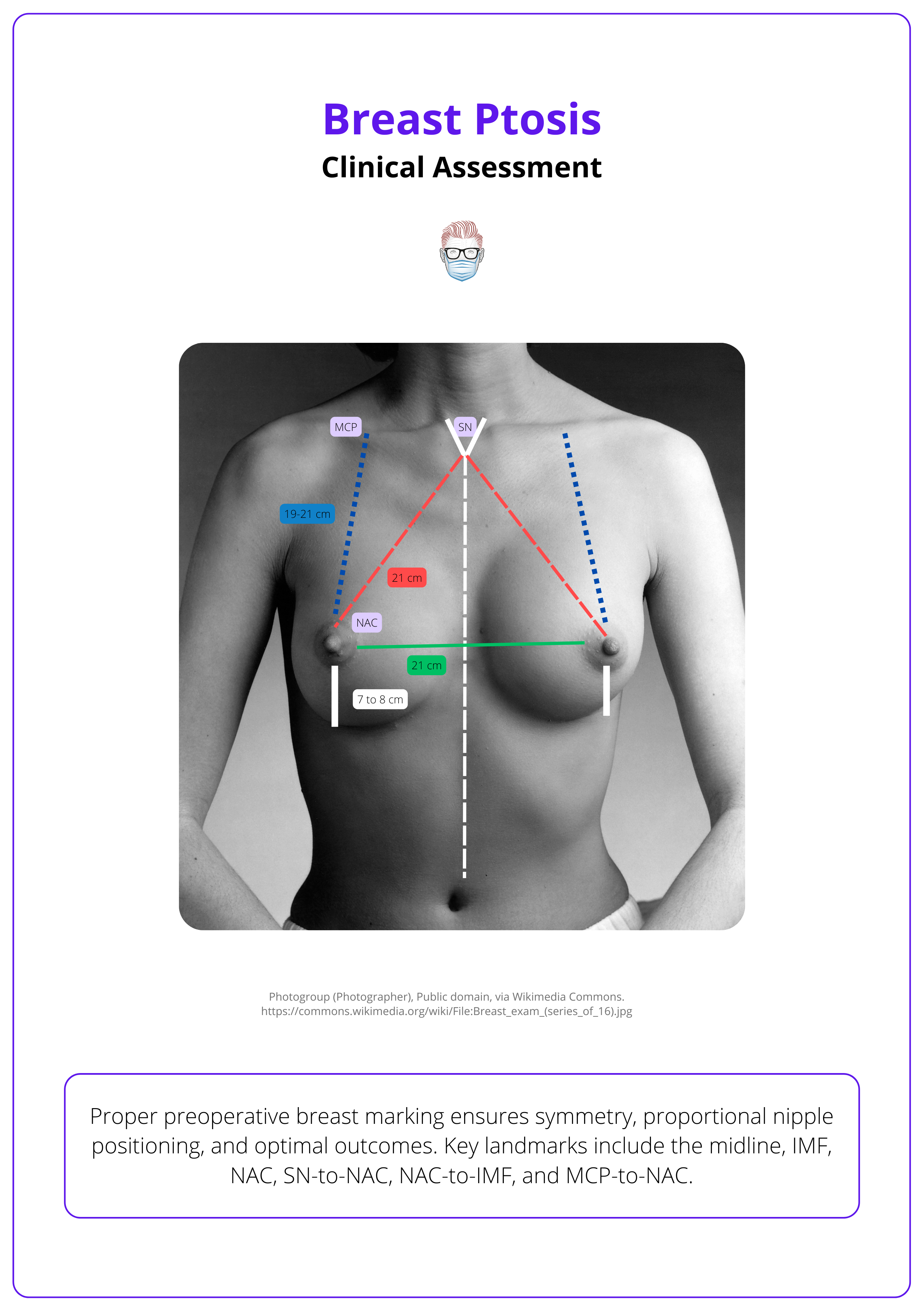 Breast Ptosis: Classification, Assessment, & Surgical Management