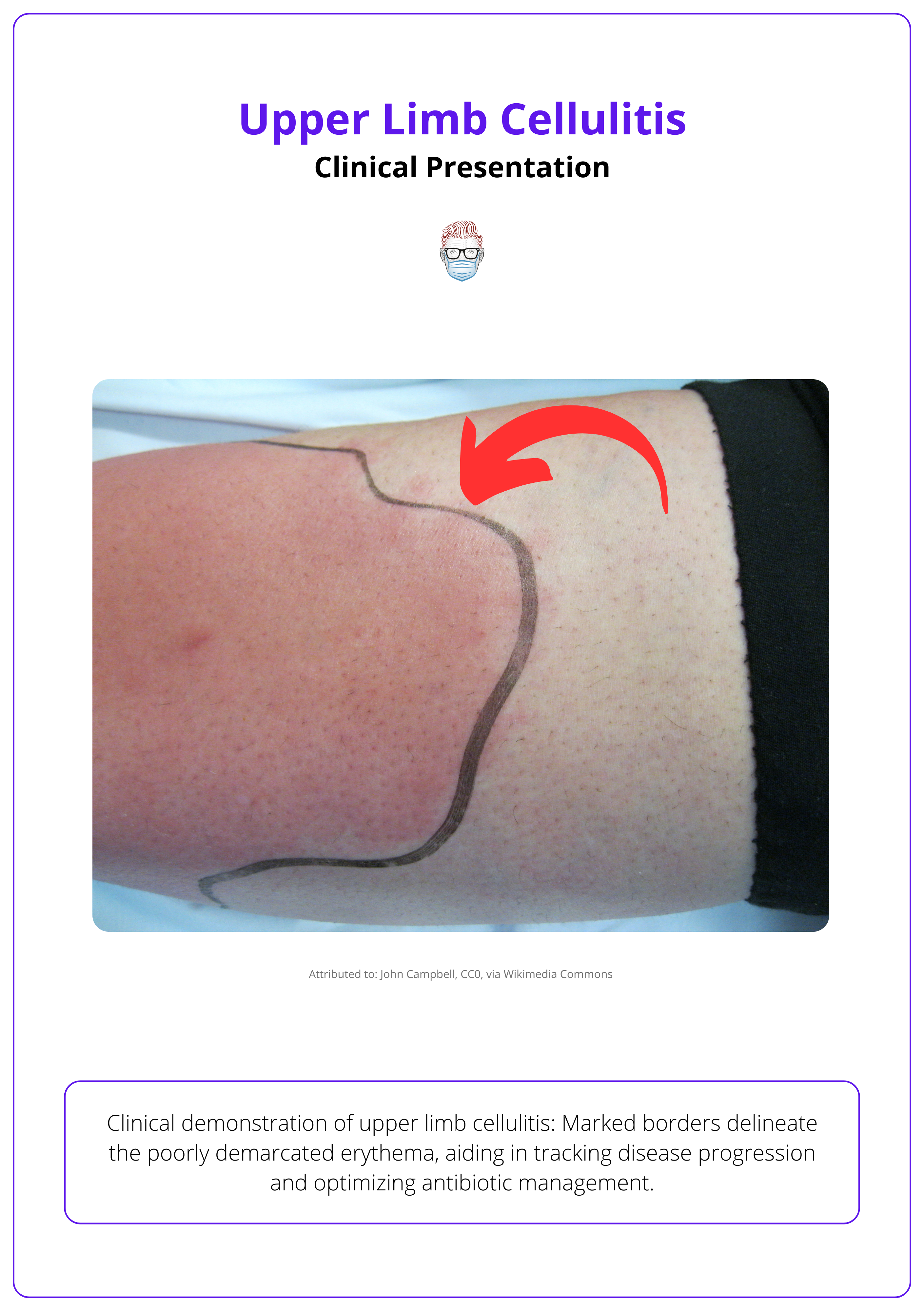 Upper Limb Cellulitis: Diagnosis, Management,& Complications