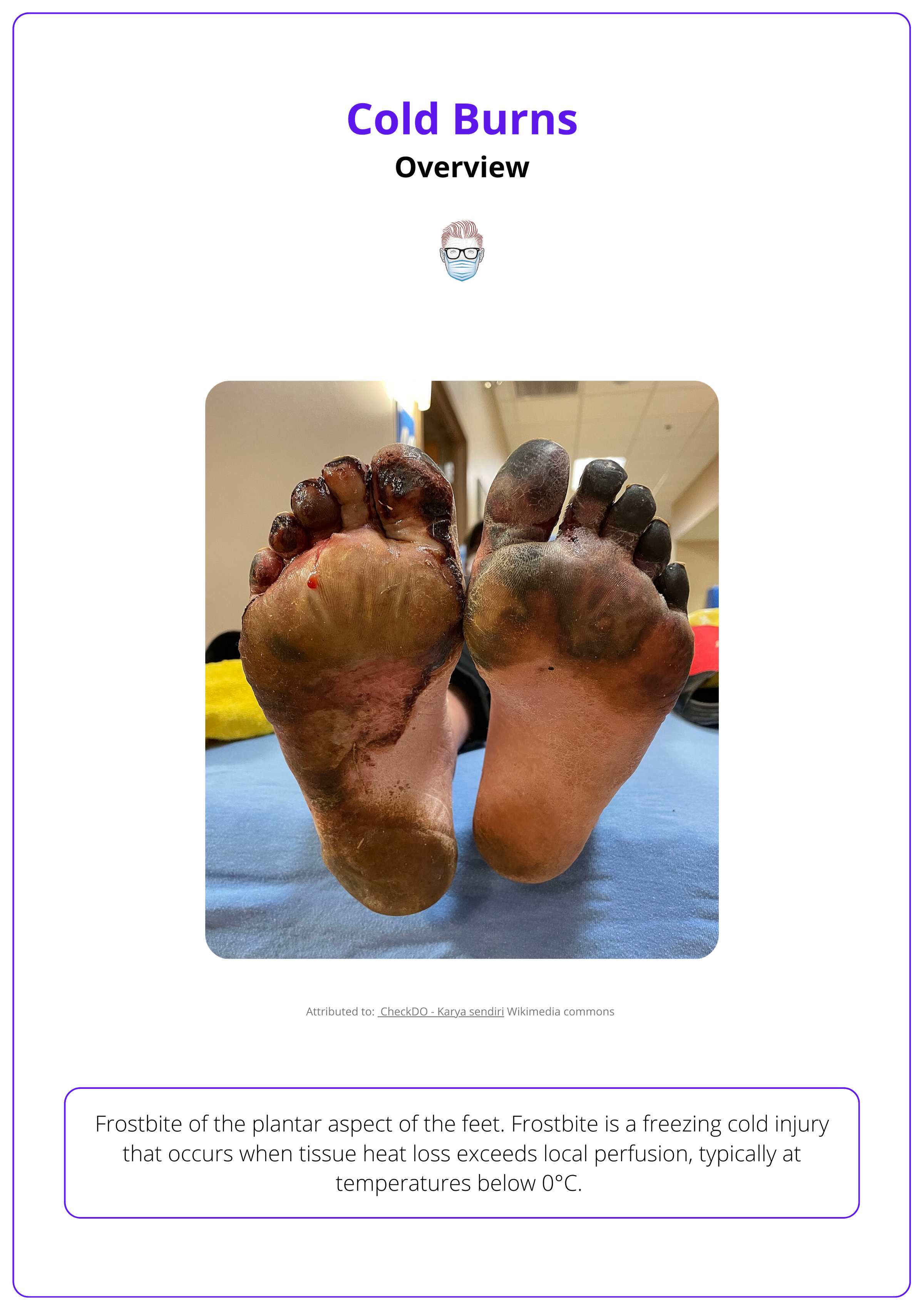 Cold Burns: Causes, Clinical Presentation, & Treatment