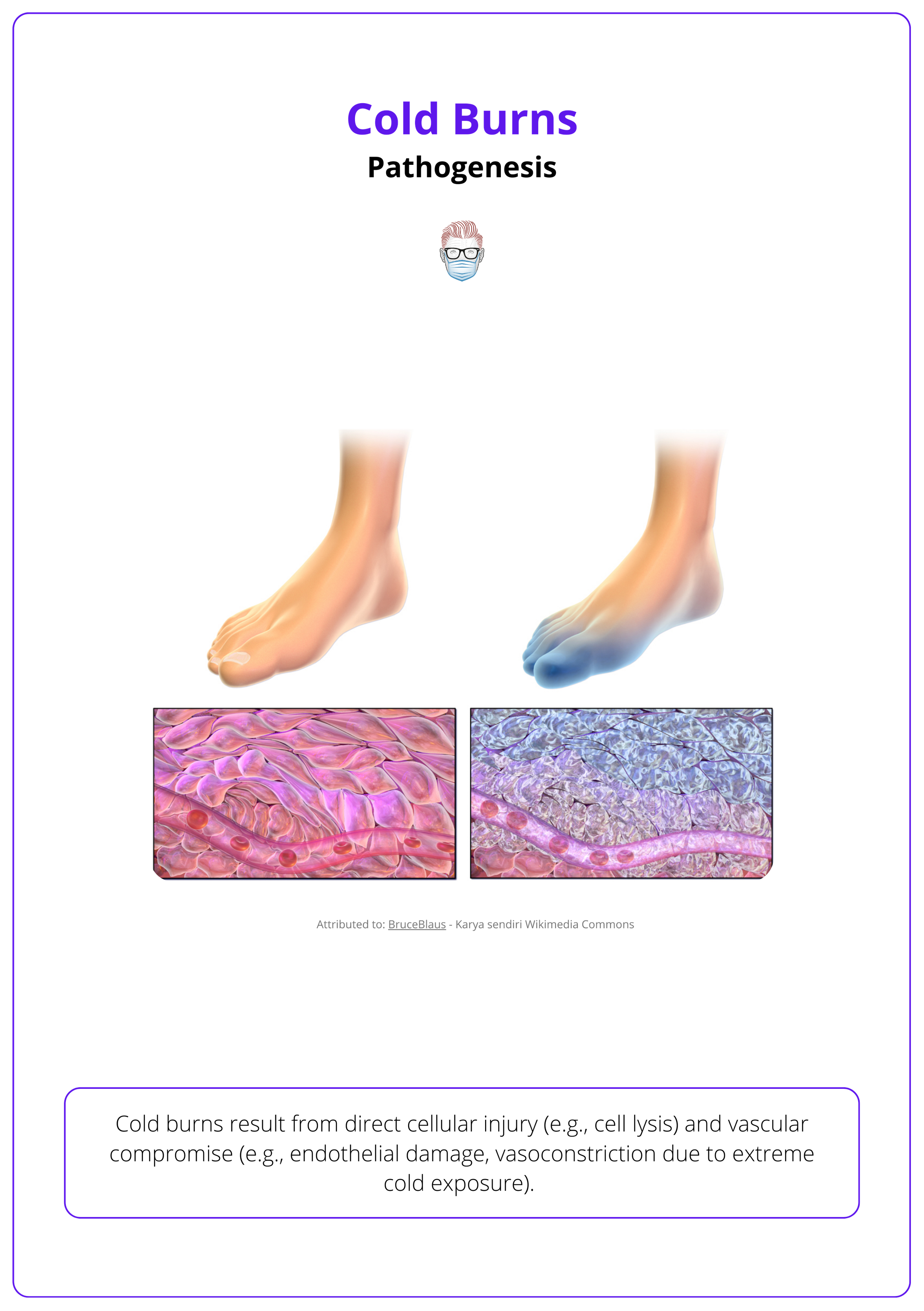 Cold Burns: Causes, Clinical Presentation, & Treatment