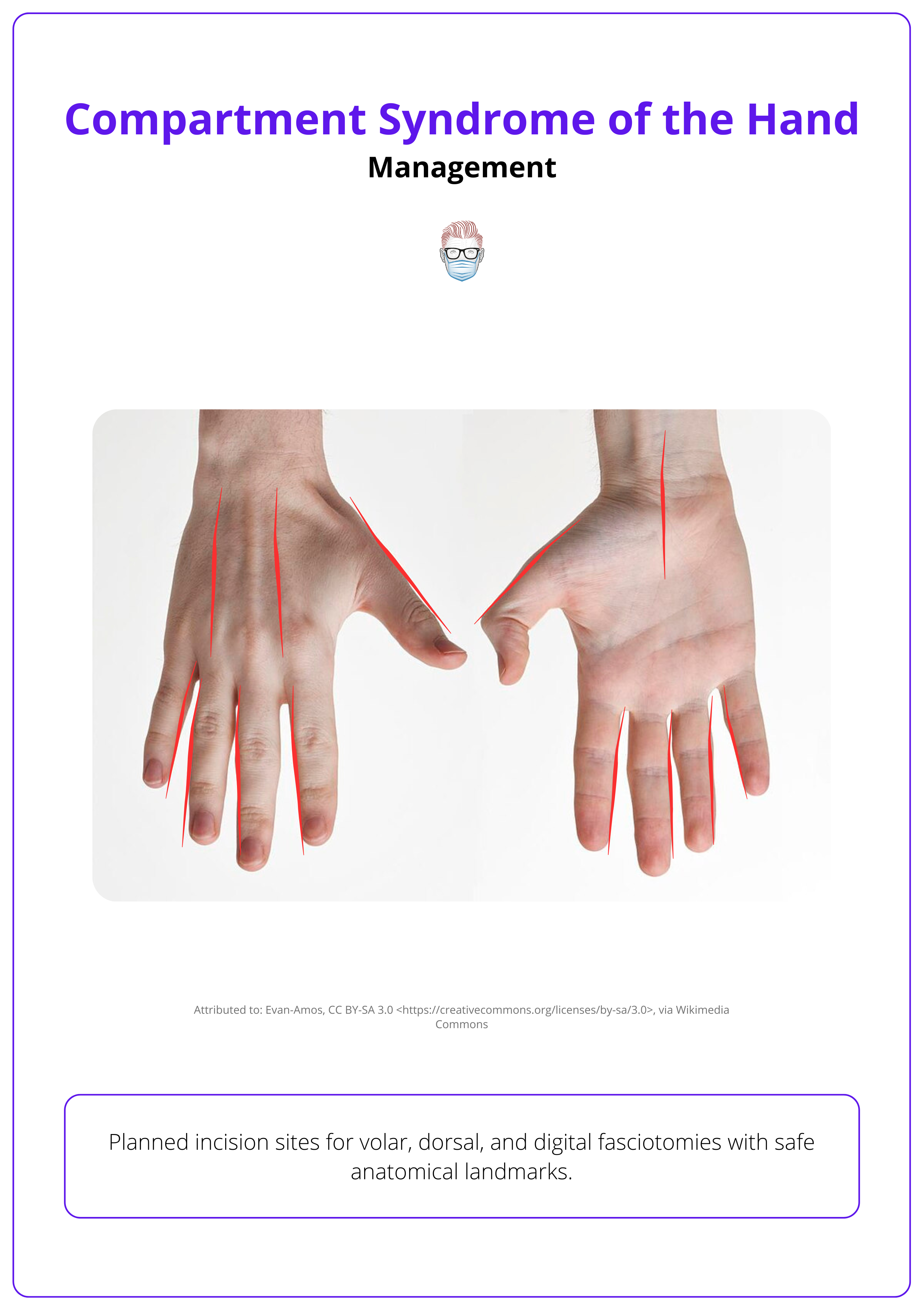 Compartment Syndrome of the Hand: Clinical Assessment, Investigations ...
