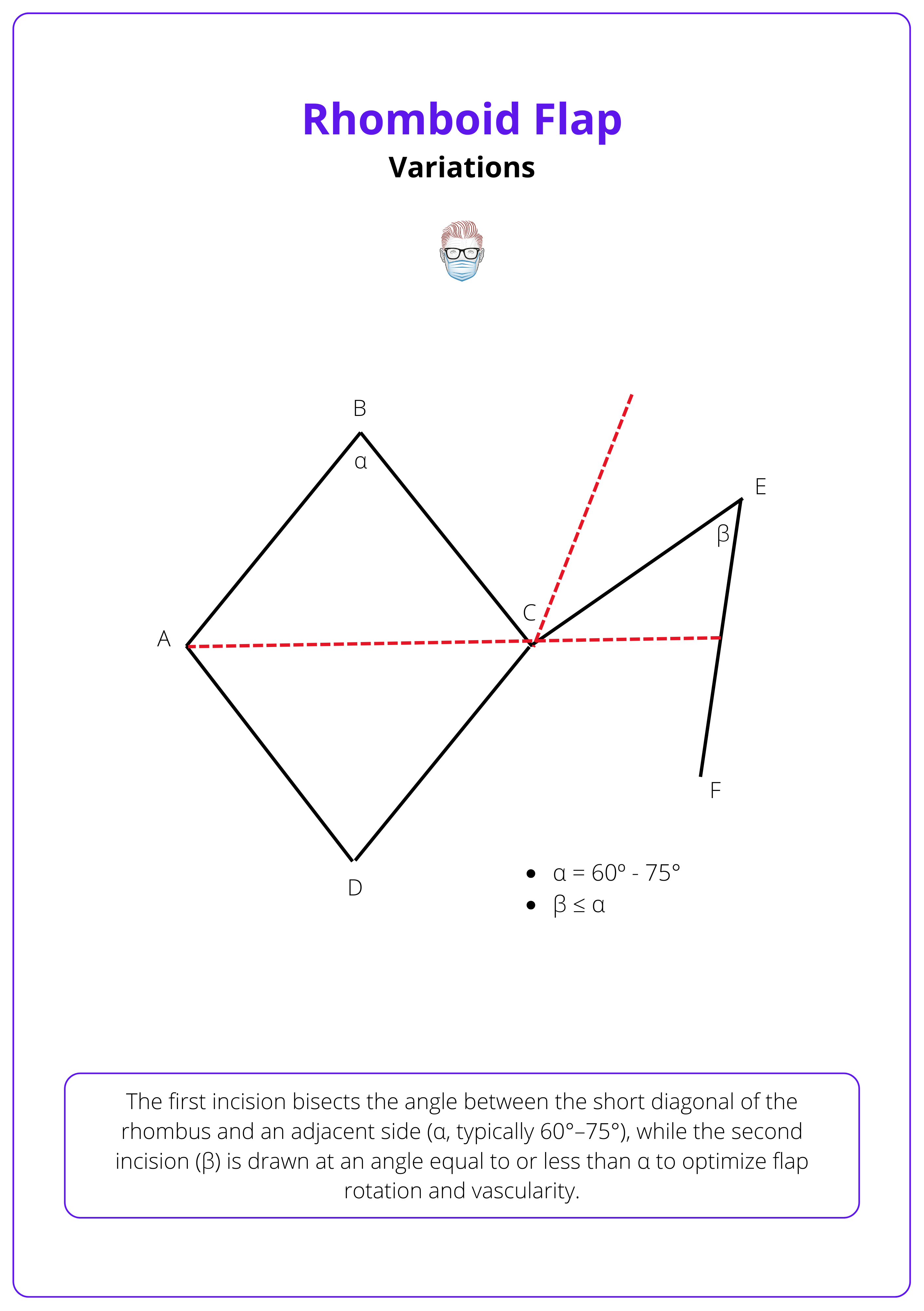Rhomboid Flap: Design, Surgical Technique, & Complications