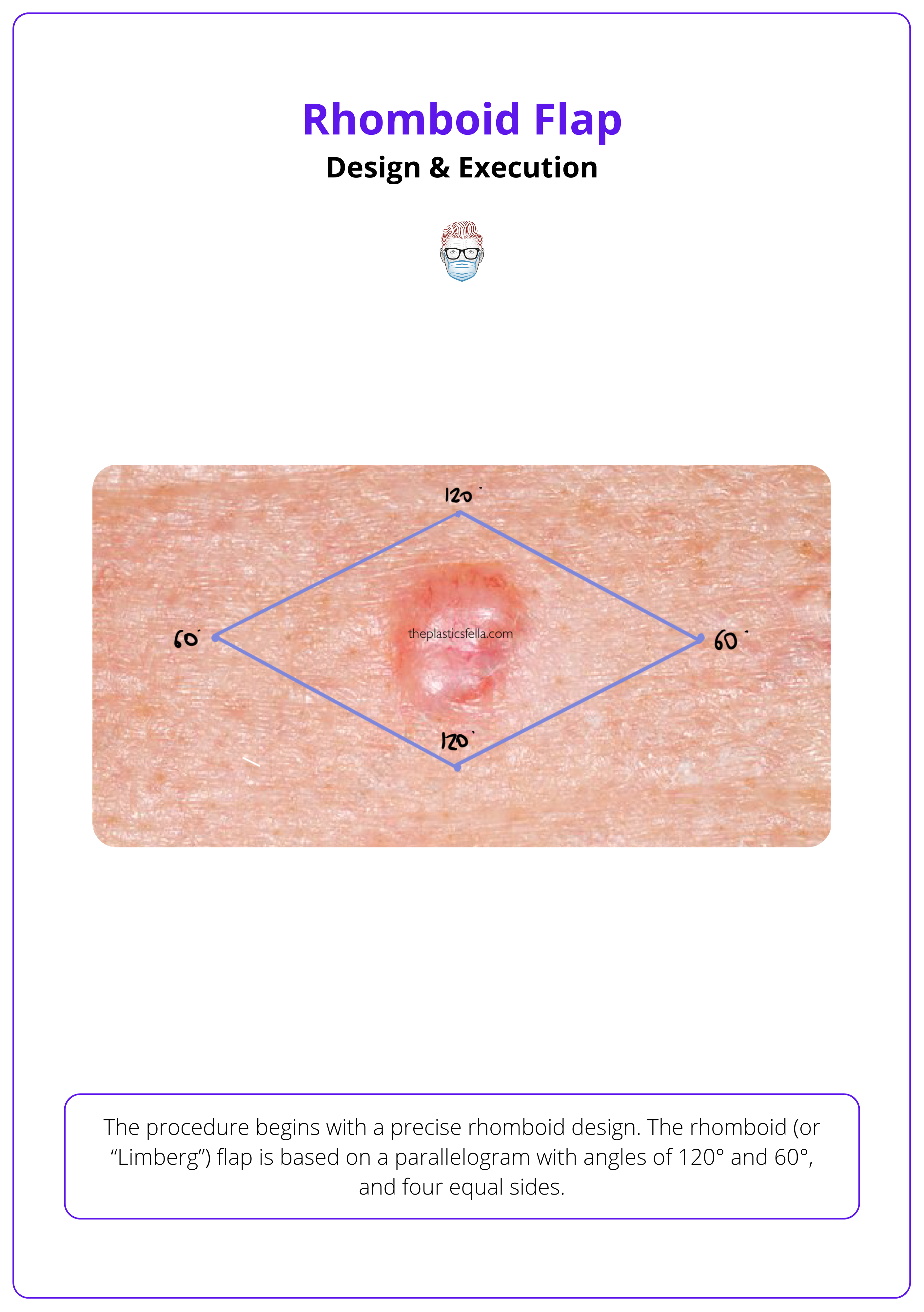 Rhomboid Flap: Design, Surgical Technique, & Complications