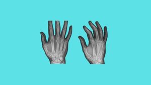 Bennett Fracture - X-Rays, Diagnosis, Treatment.