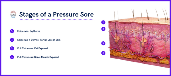 Pressure Ulcers/Sores - Classification, Illustrations, Treatment