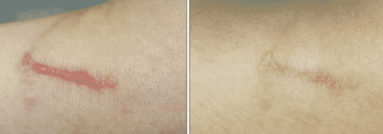 Hypertrophic Vs Keloid Scar