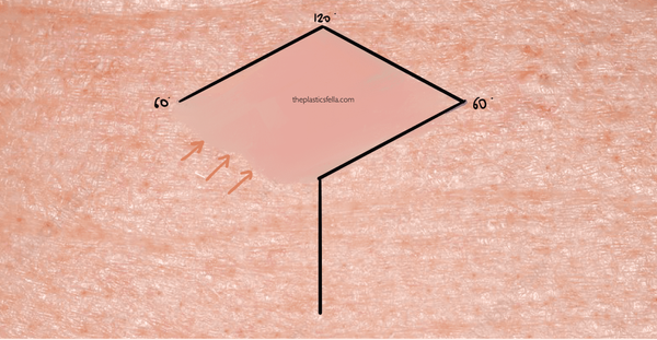 Rhomboid Flap - Indications, Design, Examples