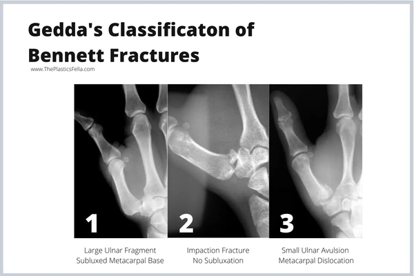 Bennett Fracture - X-Rays, Diagnosis, Treatment.