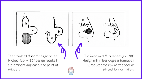 Bilobed Flaps - Indications, Design, Pictures