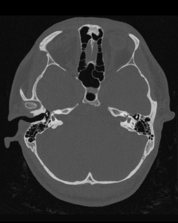 Microtia: Causes, Classifications, & Surgery