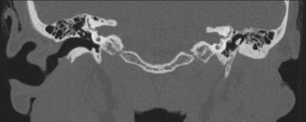 Microtia: Causes, Classifications, & Surgery
