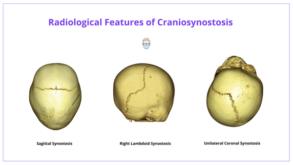 Craniosynostosis: Anatomy, Classification, & Investigations