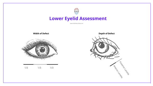 Lower Eyelid Reconstruction · Algorithm, Techniques & Illustrations