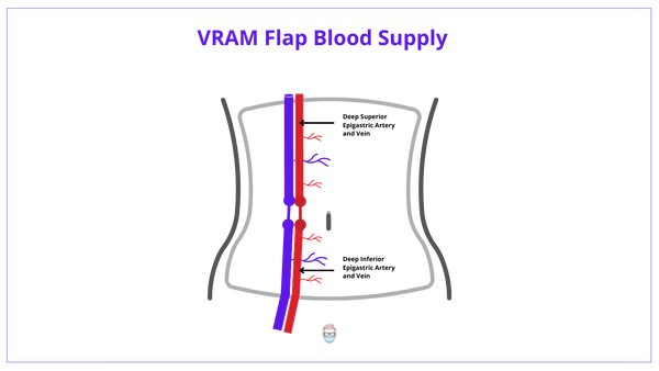 VRAM Flap - Indications, Anatomy, Technique (+ Images)