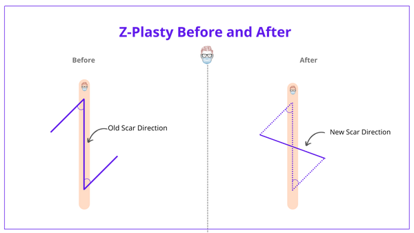 Z-Plasty: Designs, Indications, Variations and Complications