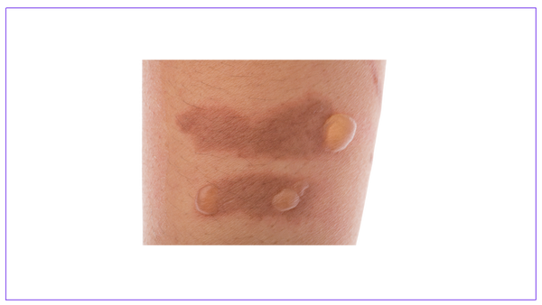 Burn Depth - Classification, Assessment, Characteristics.