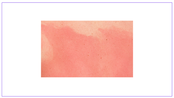 Burn Depth - Classification, Assessment, Characteristics.