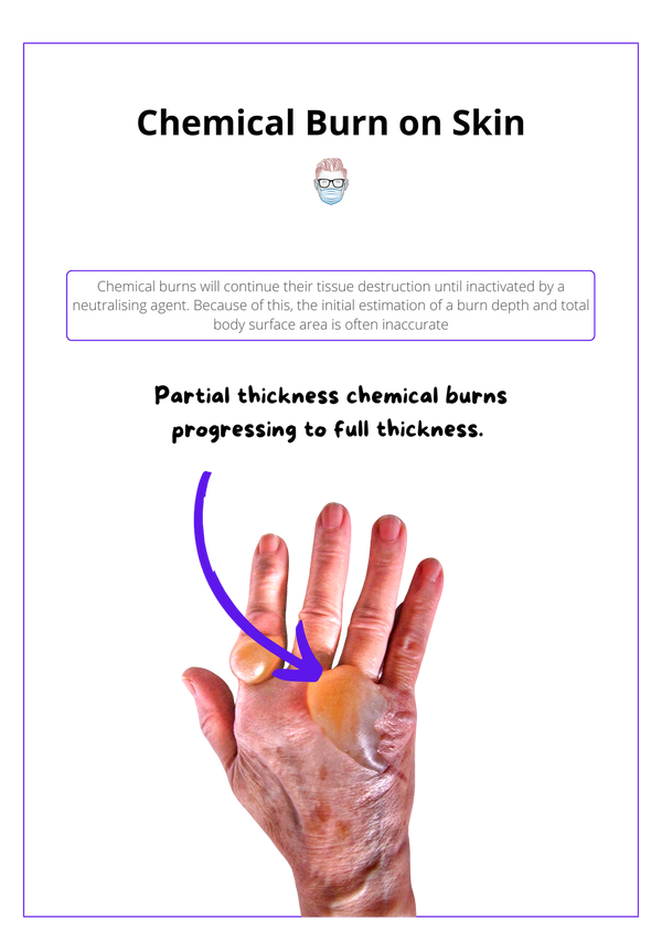 Chemical Burns · Types, Complications, Management