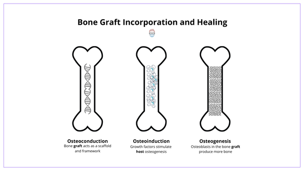 Bone Grafts