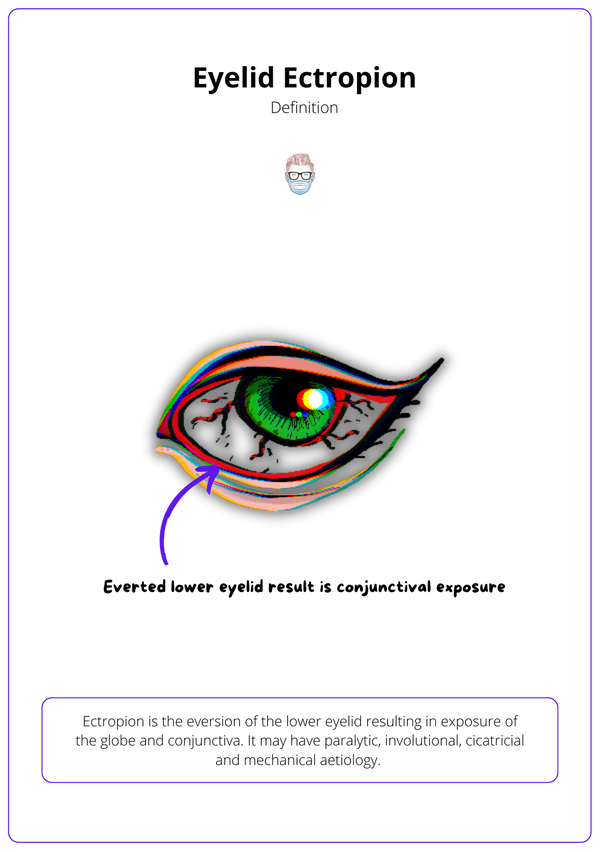 Ectropion: Causes, Assessment, & Treatment