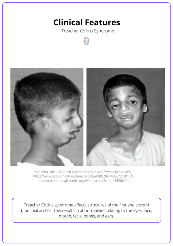 Treacher Collins Syndrome: Clinical Features, Genetics, & Treatment