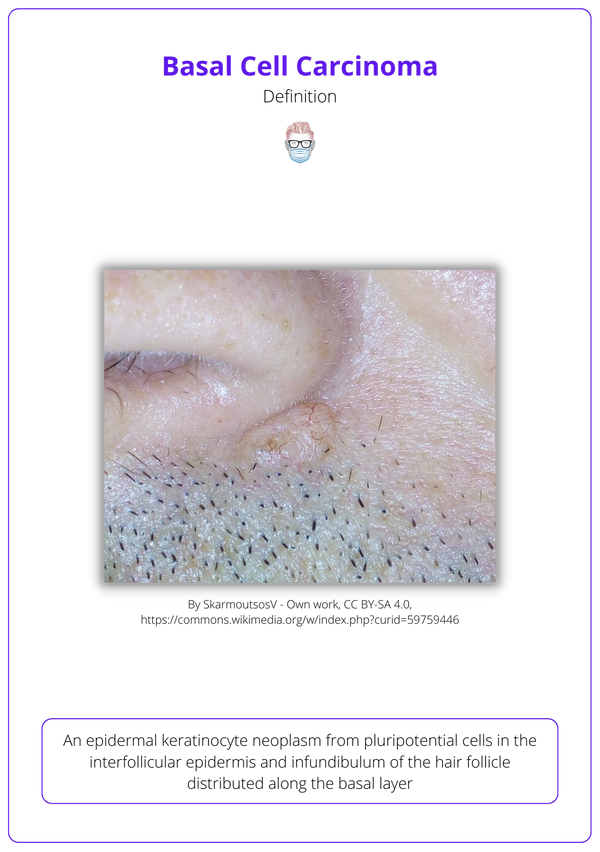 Basal Cell Carcinoma (BCC) · Aetiology, Diagnose, Treat, Follow-up