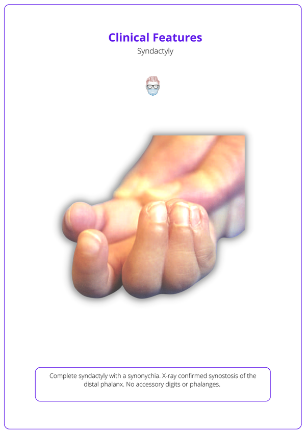 Syndactyly: Causes, Diagnosis, & Treatment