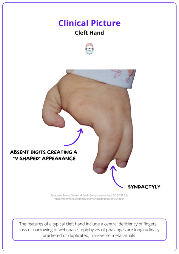 Cleft Hand · Features, Classification, Treatment.