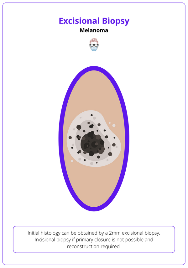 Melanoma Diagnosis Features Sentinel Node And Staging