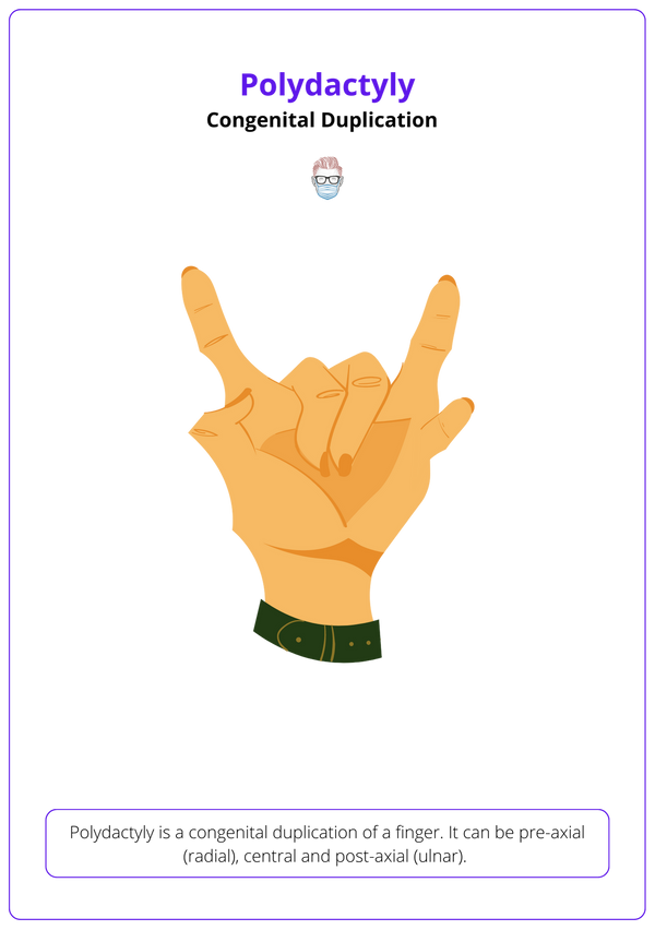 Polydactyly: Classification & Treatment