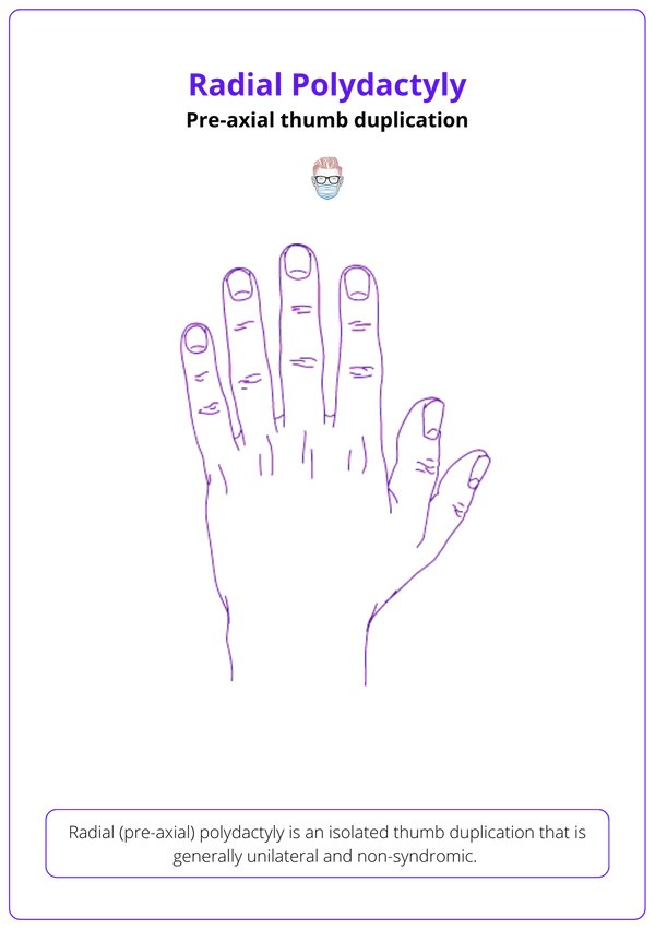 Polydactyly: Classification & Treatment