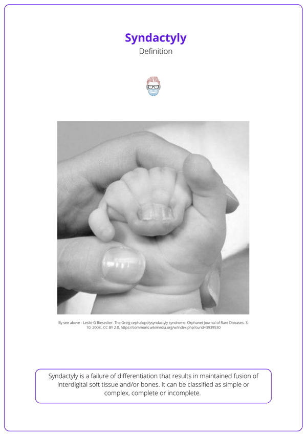 Syndactyly: Causes, Diagnosis, & Treatment