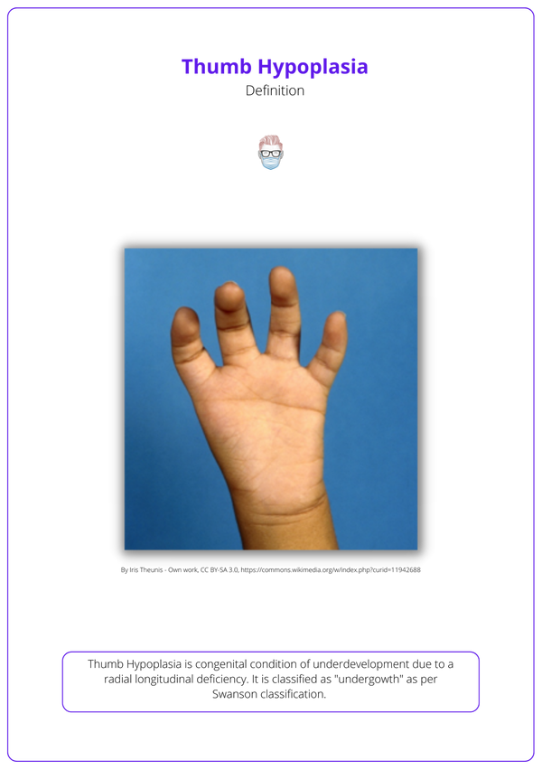 Thumb Hypoplasia: Blauth Classification, Diagnosis, & Treatment