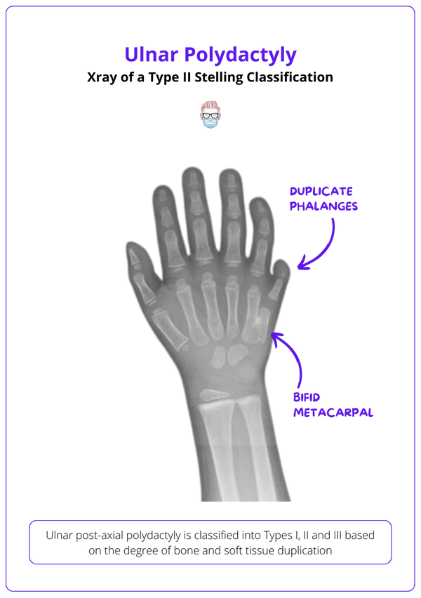 Polydactyly: Classification & Treatment