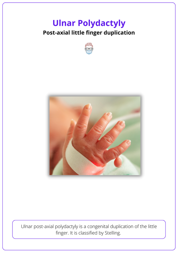 Polydactyly: Classification & Treatment