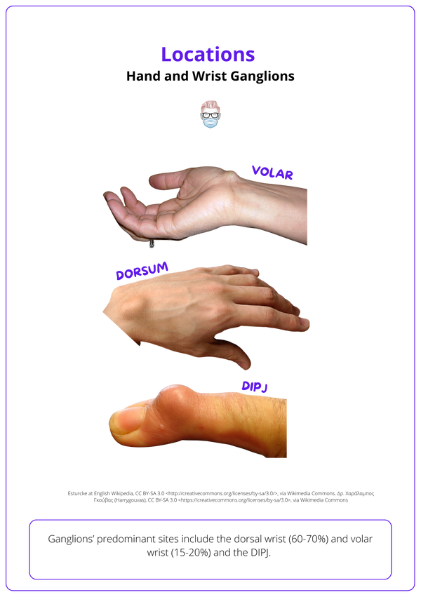 Ganglion Cysts of the Hand & Wrist: Diagnosis and Treatment