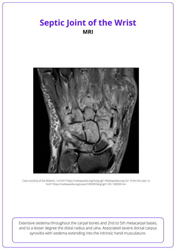 Septic Arthritis of the Hand: Causes, Diagnosis, & Treatment