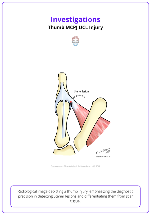 Thumb MCPJ UCL Injury: Thumb Anatomy, Diagnosis & Management