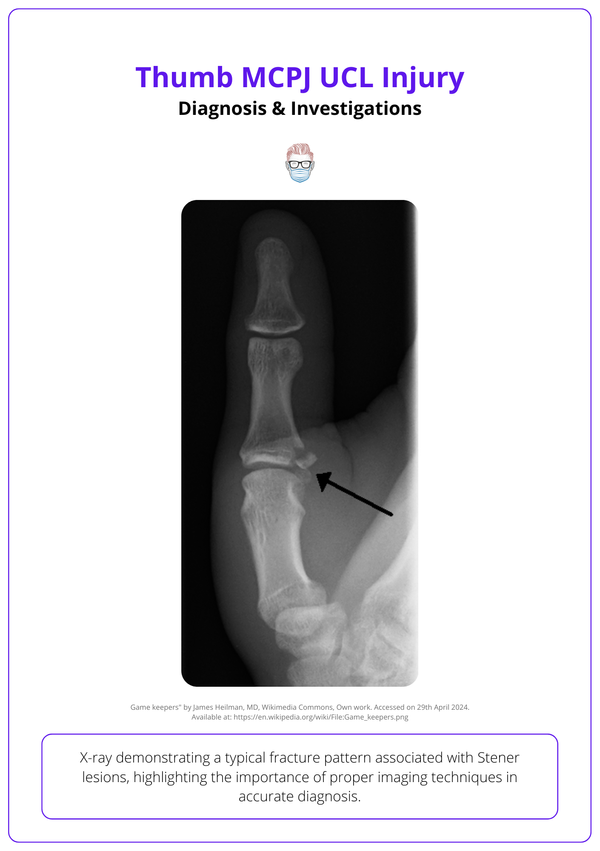 Thumb MCPJ UCL Injury: Thumb Anatomy, Diagnosis & Management