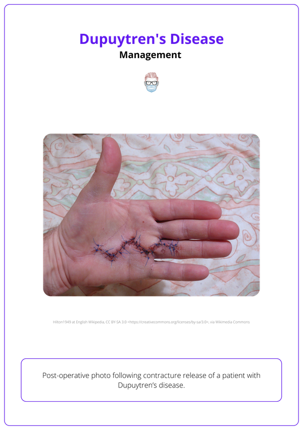 Dupuytren's Disease: Pathoanatomy, Clinical Assessment, & Management