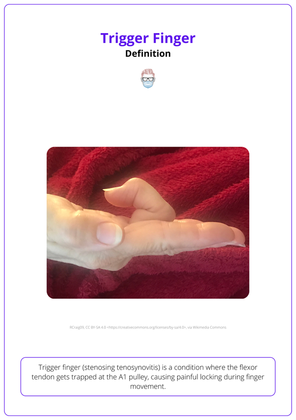 Trigger Finger: Anatomy, Clinical Features, & Management