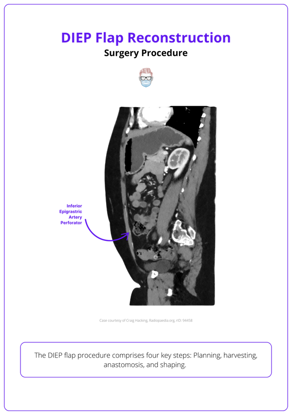 DIEP Flap Reconstruction: Anatomy, Key Surgical Steps, & Complications