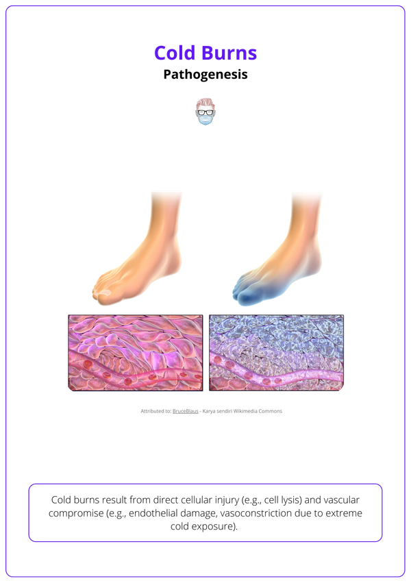 Cold Burns: Causes, Clinical Presentation, & Treatment