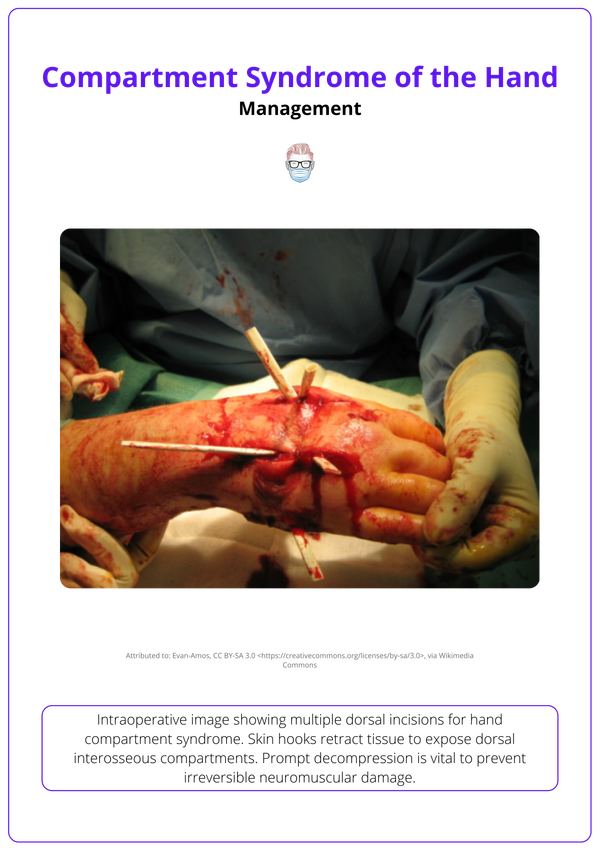 Compartment Syndrome of the Hand: Clinical Assessment, Investigations ...