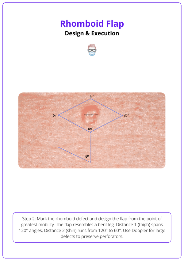 Rhomboid Flap: Design, Surgical Technique, & Complications